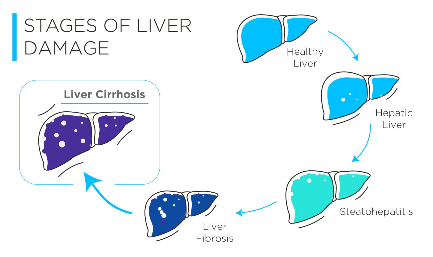 Liver Breath Analysis (LIBRA®)